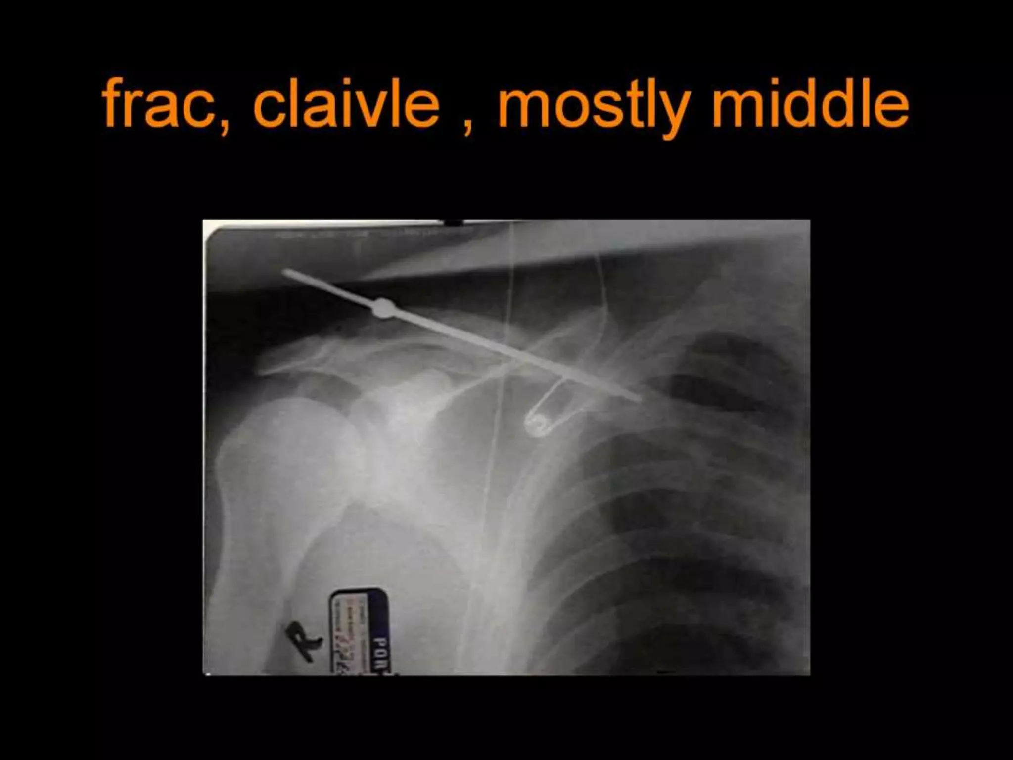 59-Dr Ahmed Esawy imaging oral board MSK imaging part V fracture B ...