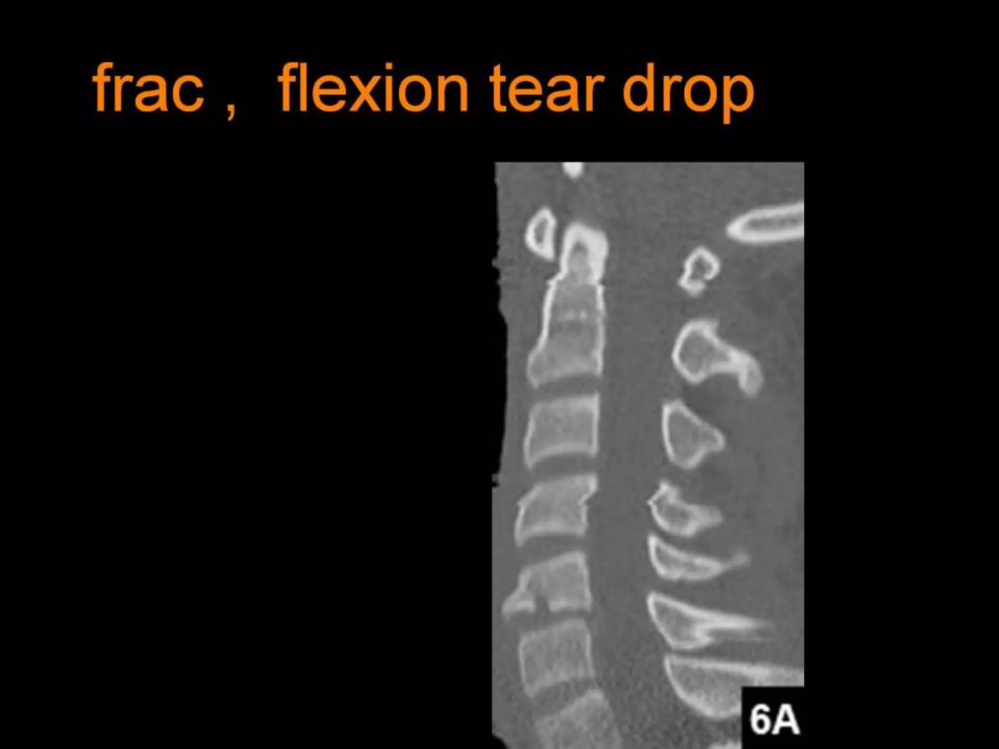 59-Dr Ahmed Esawy imaging oral board MSK imaging part V fracture B ...