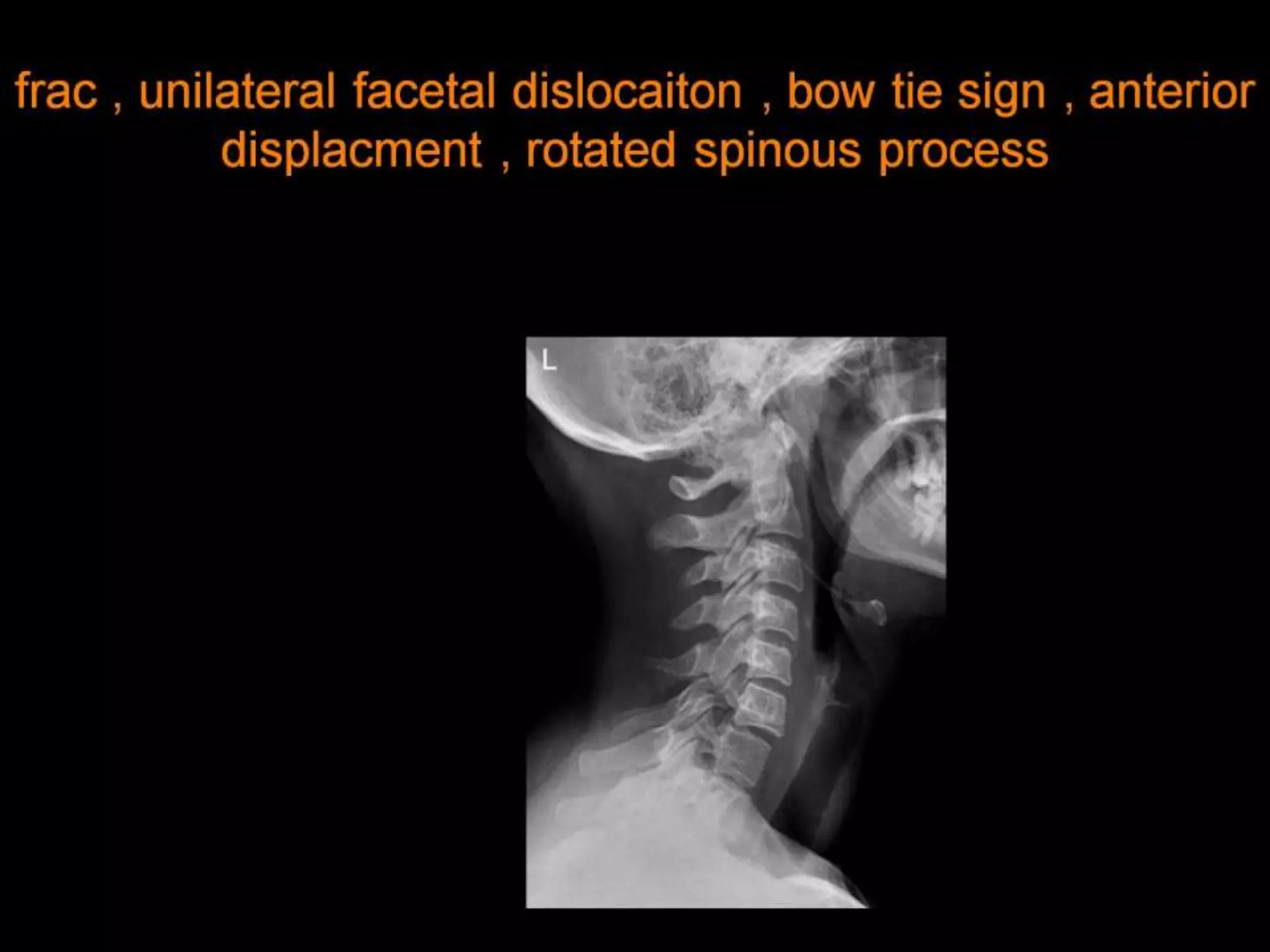59-Dr Ahmed Esawy imaging oral board MSK imaging part V fracture B ...