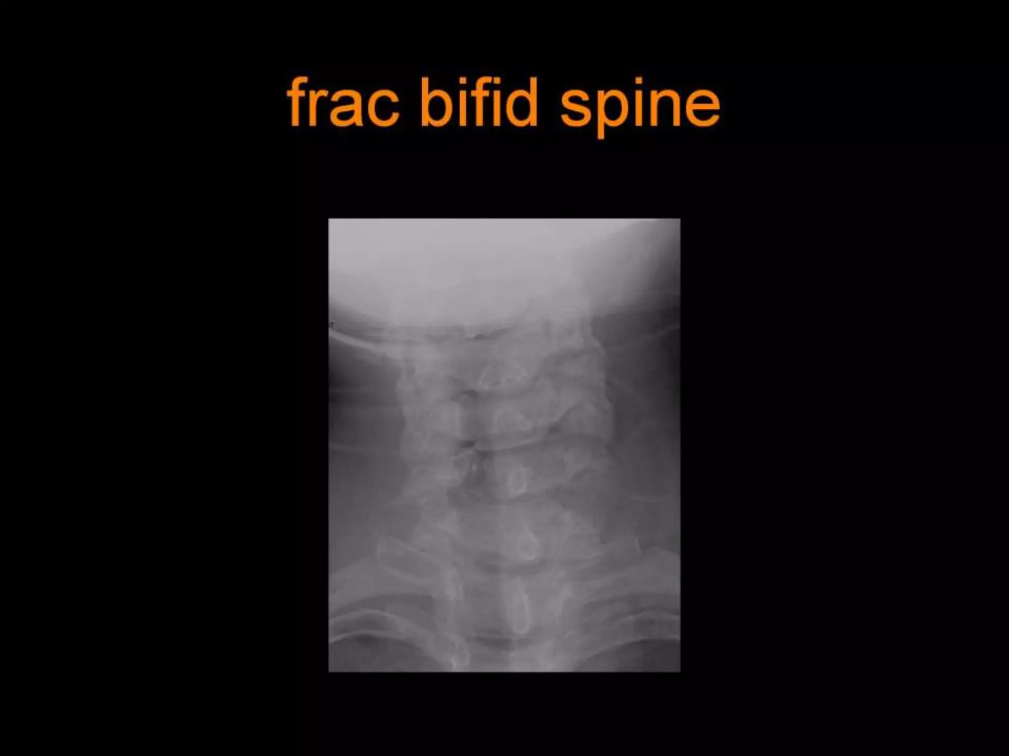 59-Dr Ahmed Esawy imaging oral board MSK imaging part V fracture B ...