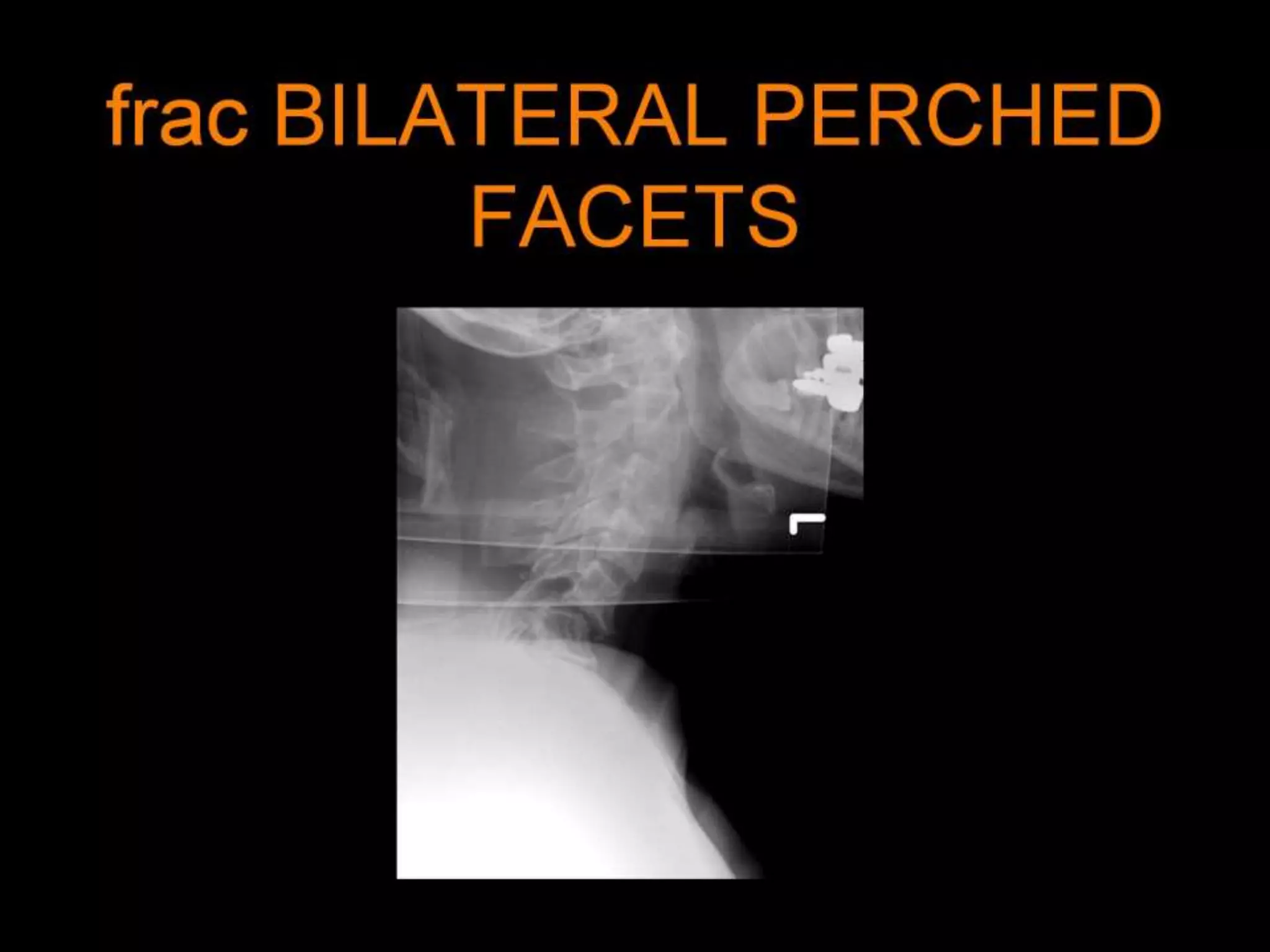 59-Dr Ahmed Esawy imaging oral board MSK imaging part V fracture B ...