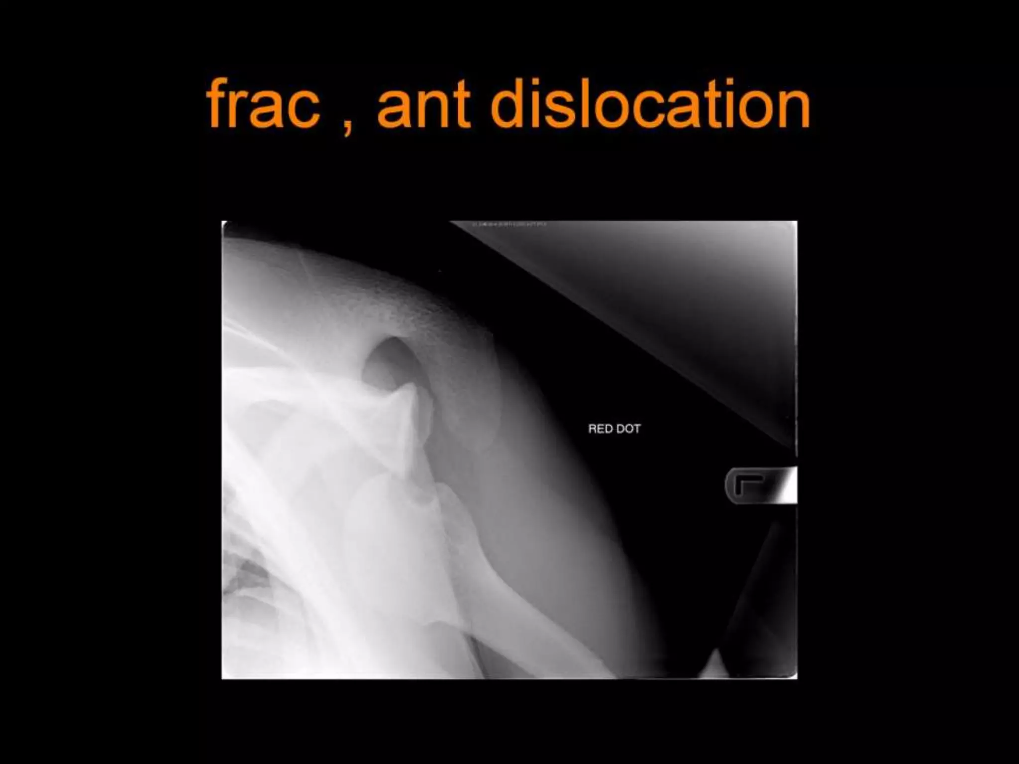 59-Dr Ahmed Esawy imaging oral board MSK imaging part V fracture B | PPT