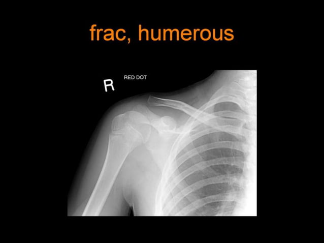 59-Dr Ahmed Esawy imaging oral board MSK imaging part V fracture B ...
