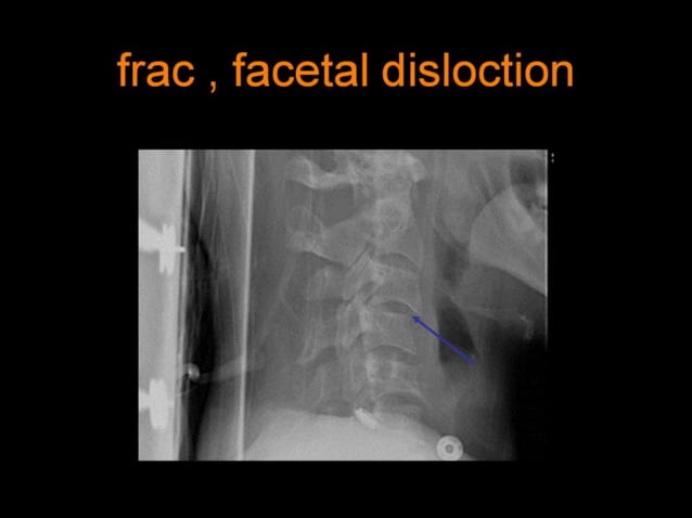 59-Dr Ahmed Esawy imaging oral board MSK imaging part V fracture B ...