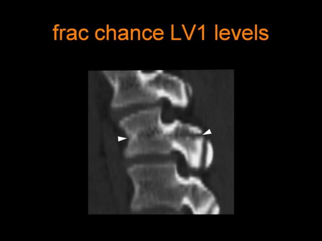 59-Dr Ahmed Esawy imaging oral board MSK imaging part V fracture B | PPT