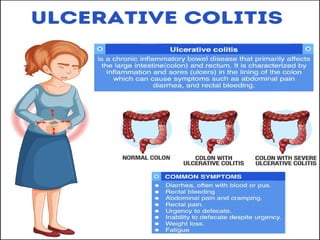 Ulcerative Colitis by Kushal.pptx. A very knowledgeable presentation pn ...