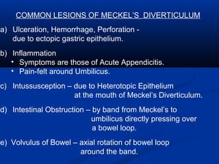 Atypical meckel's diverticulum- DR. VISWAROOPA CHARI | PPT