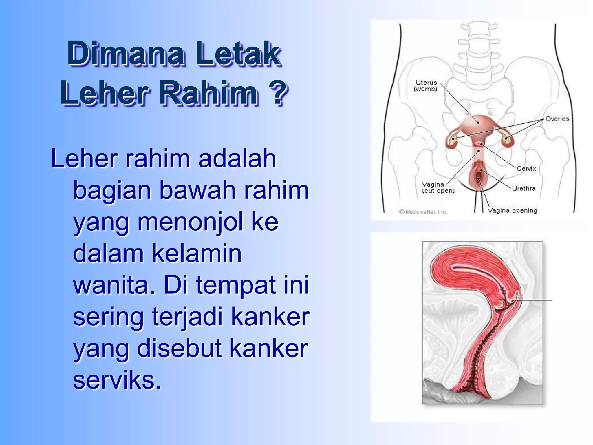 59592899 kangker-serviks | PPT
