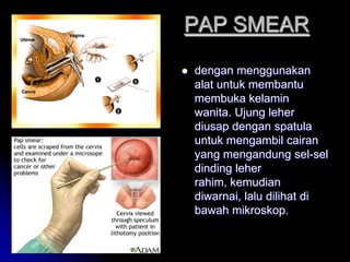 59592899 kangker-serviks | PPT