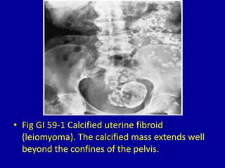 59 female genital tract calcification | PPT