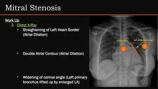 Mitral Valve anatomy and its Disorders.pptx