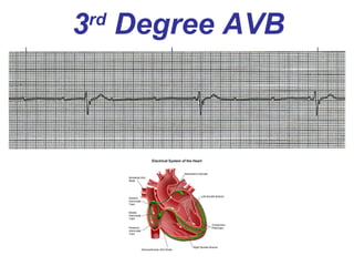 Atrioventricular Blocks - BMH/Tele | PPT | Heart and Cardiovascular ...