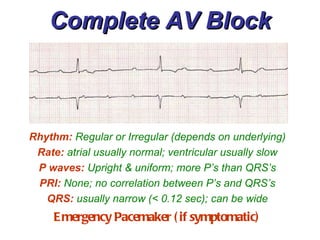 Atrioventricular Blocks - BMH/Tele | PPT