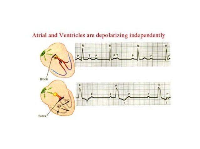 Atrioventricular Blocks - BMH/Tele | PPT | Heart and Cardiovascular ...