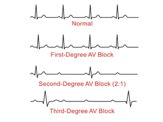Atrioventricular Blocks - BMH/Tele | PPT | Heart and Cardiovascular ...