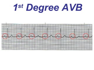 Atrioventricular Blocks - BMH/Tele | PPT | Heart and Cardiovascular ...
