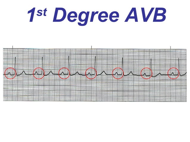 Atrioventricular Blocks - BMH/Tele | PPT | Heart and Cardiovascular ...