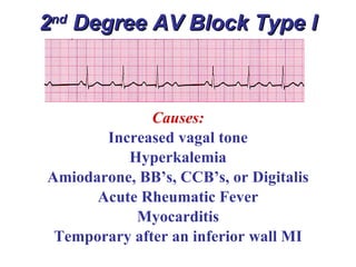 Atrioventricular Blocks - BMH/Tele | PPT | Heart and Cardiovascular ...