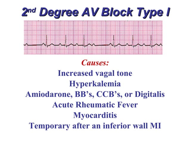 Atrioventricular Blocks - BMH/Tele | PPT | Heart and Cardiovascular ...