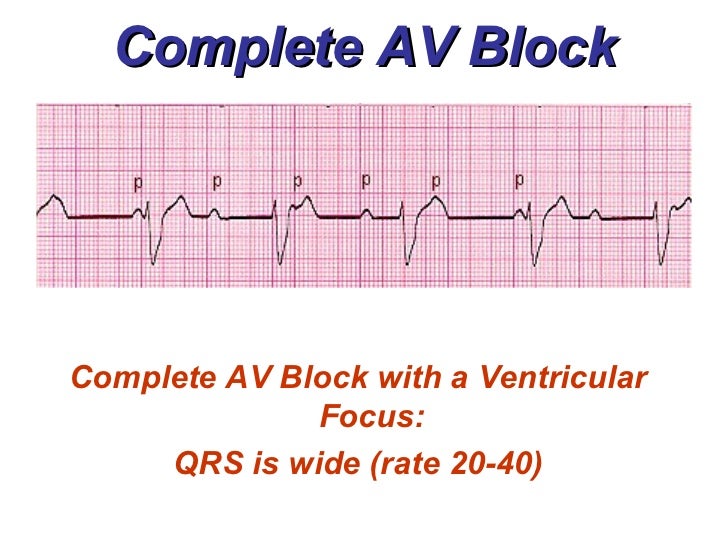 Atrioventricular Blocks - BMH/Tele