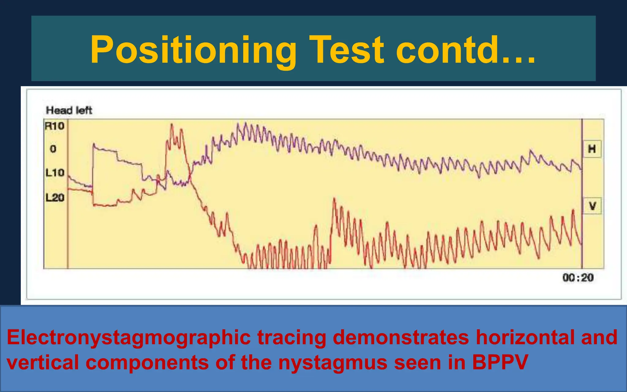 Vestibular_tests_sundar in otolaryngology .pptx