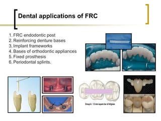 advances in resin composites dental material | PPS