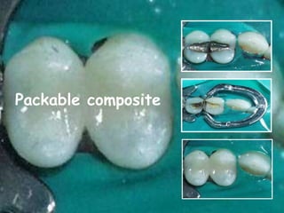 advances in resin composites dental material | PPS