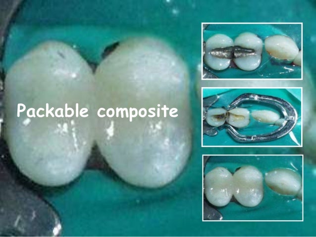 Packable Composite Dental