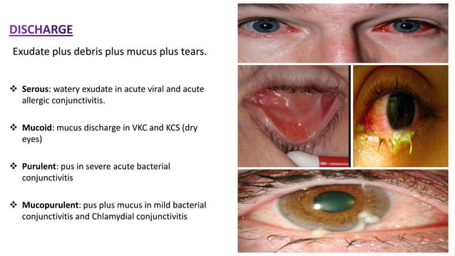anatomy of conjunctiva. Ophthalmology slides | PPTX | Eye and Vision ...