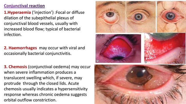 anatomy of conjunctiva. Ophthalmology slides | PPTX | Eye and Vision Conditions | Diseases and ...