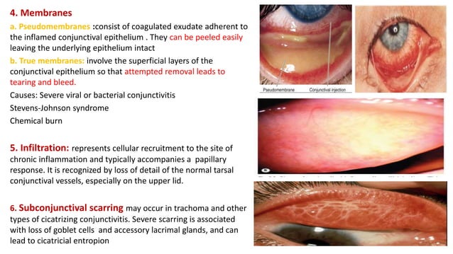 anatomy of conjunctiva. Ophthalmology slides | PPTX | Eye and Vision ...