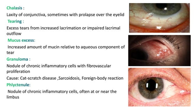 anatomy of conjunctiva. Ophthalmology slides | PPTX | Eye and Vision ...