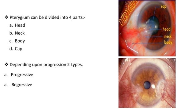 anatomy of conjunctiva. Ophthalmology slides | PPTX | Eye and Vision ...