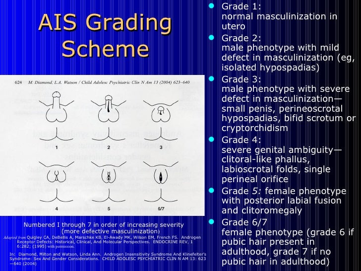 5 Androgen Insensitivity
