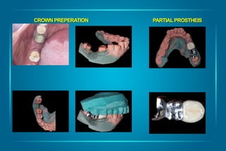 5 assorted pictures- PARTIAL CROWN exams | PPTX