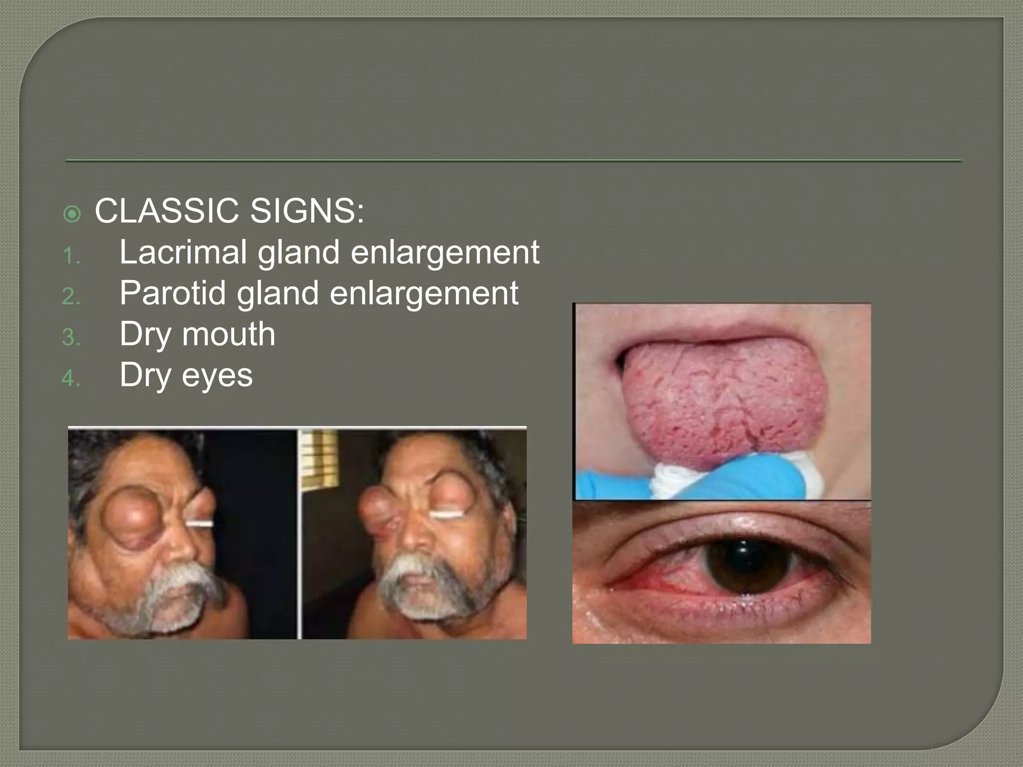 5 AUTOIMMUNE DISEASES OF SALIVARY GLAND SNISHA.pptx