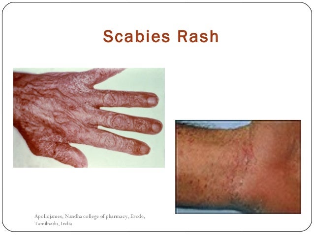 5(b)..new scabies