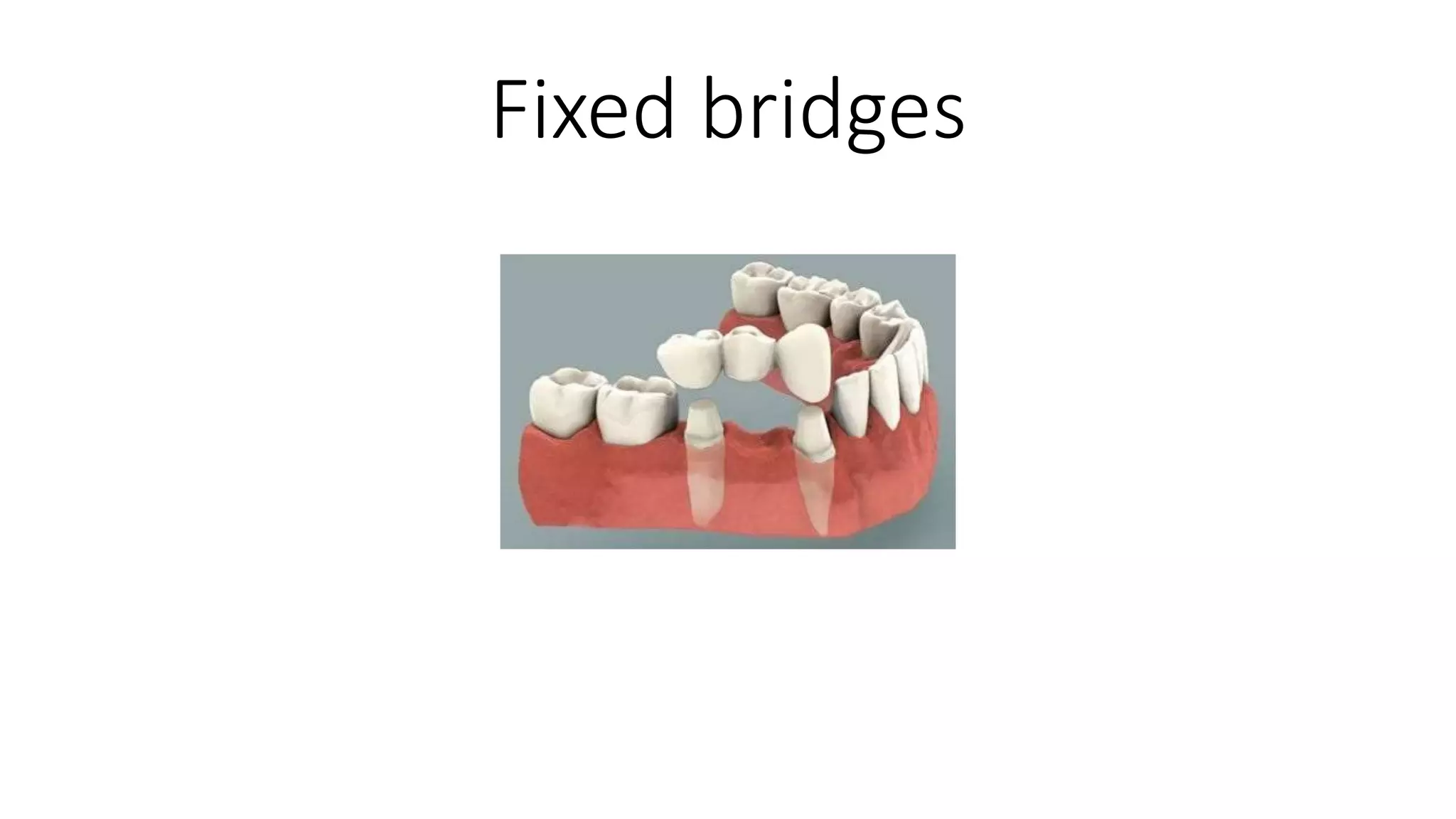 fixed bridges | PPTX