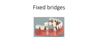 fixed bridges | PPTX