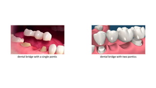 fixed bridges | PPTX