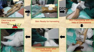 Skin Donation | PPTX
