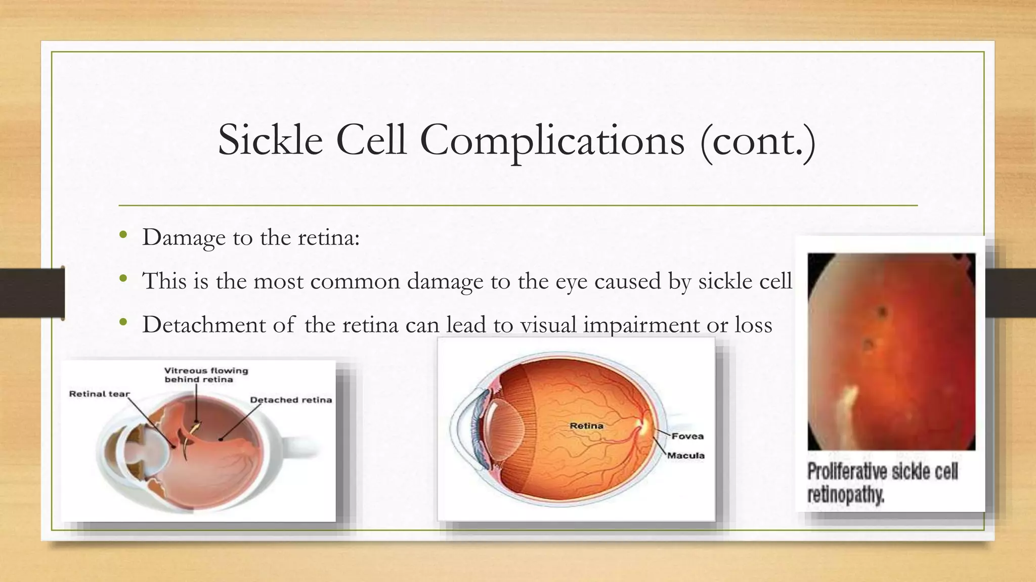 Sickle Cell Complications | PPTX