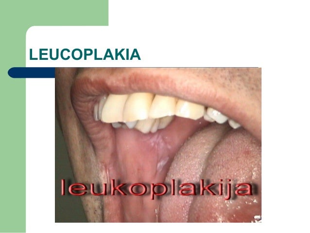 LEUCOPLAKIA