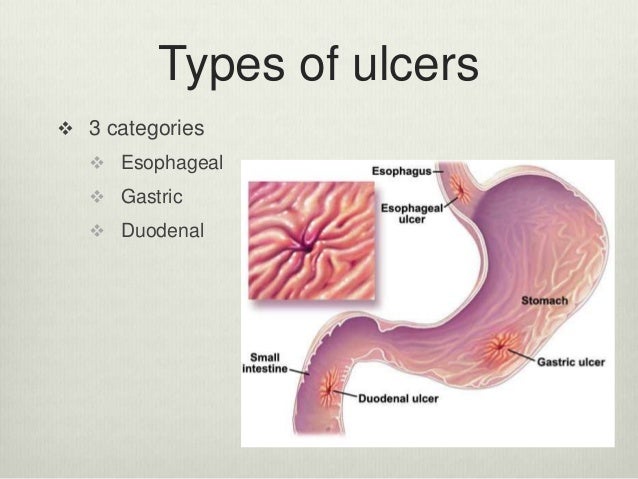 peptic ulcer draft