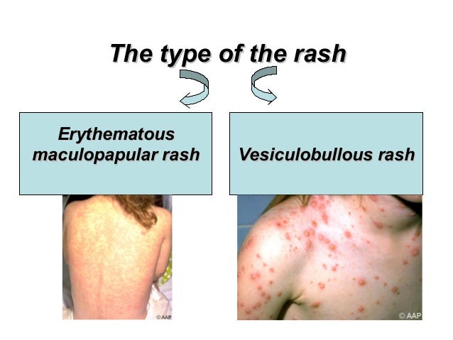 fever +rash