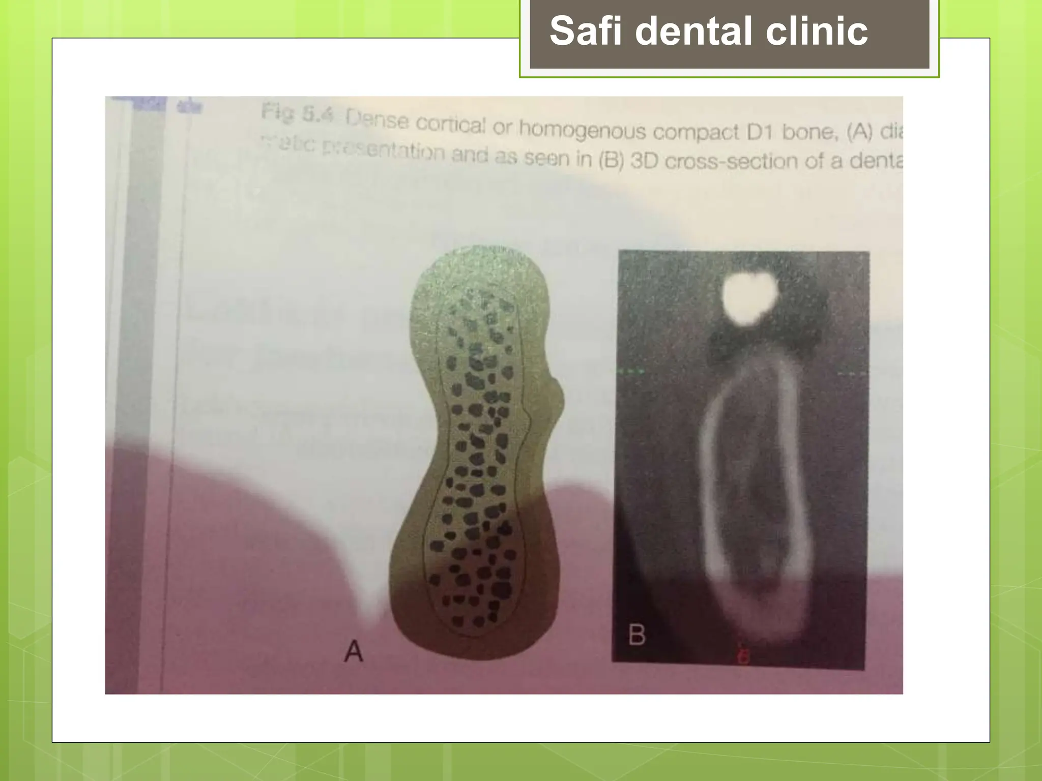 [5]bone density for dental implants [ 5 ].pptx