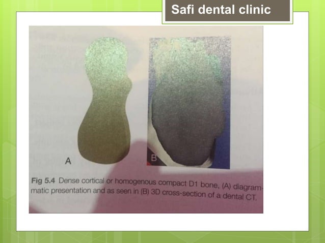[5]bone density for dental implants [ 5 ].pptx