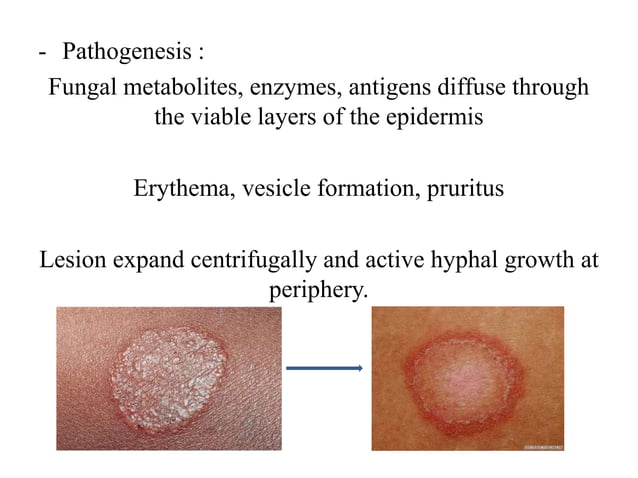 Dermatophytes | PPTX | Foot Health | Diseases and Conditions