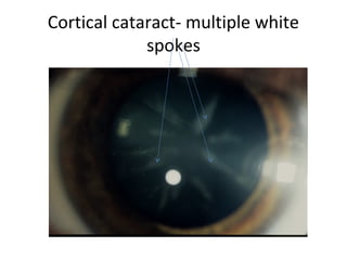 Cataract and refractive surgery | PPT