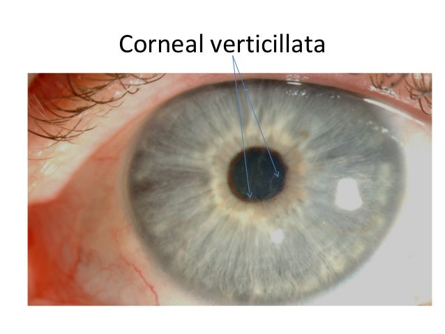 Cataract and refractive surgery